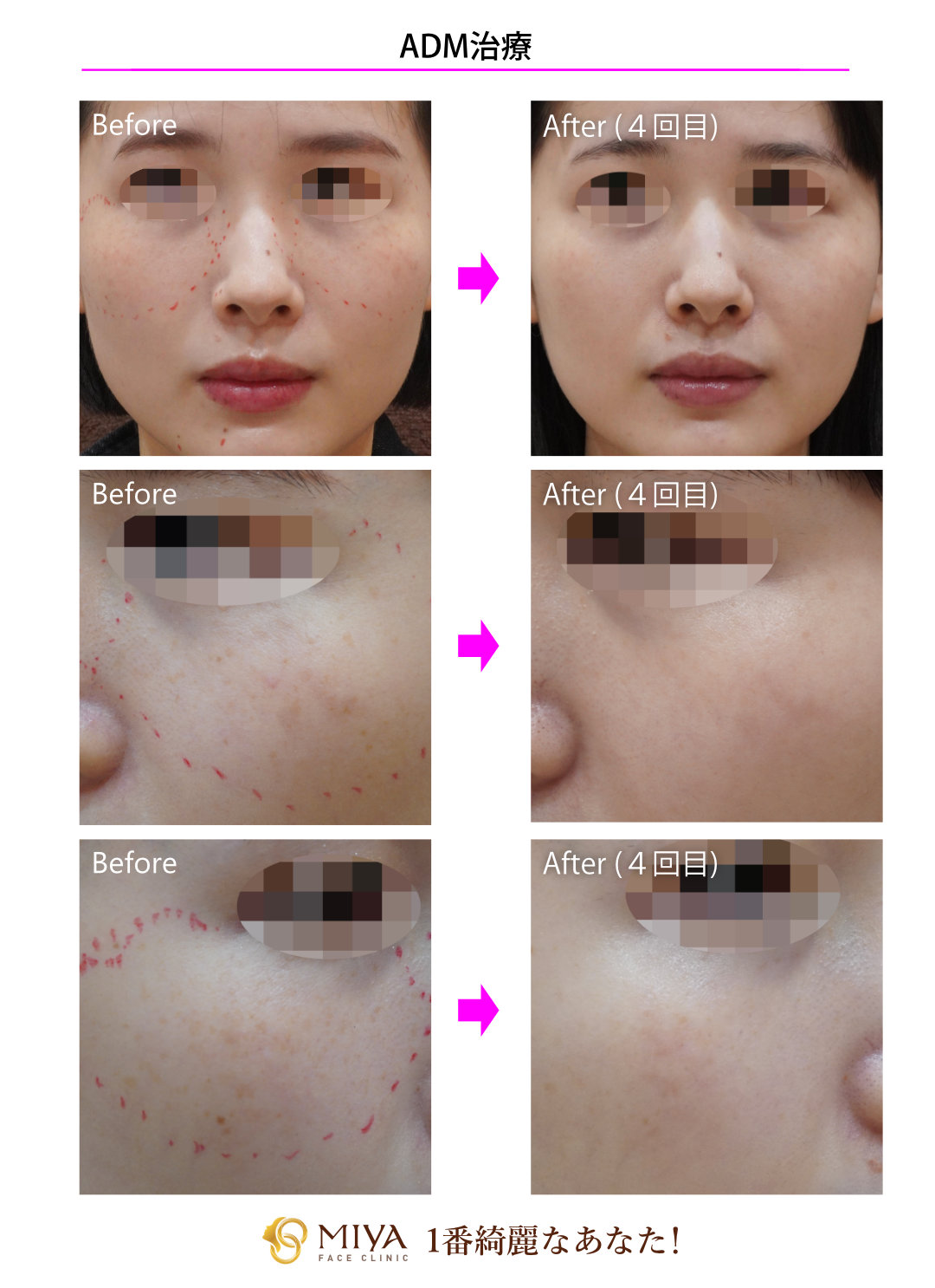 ADM治療も行っています！ | 大阪・難波で美容整形外科・美容皮膚科ならMIYAフェイスクリニック